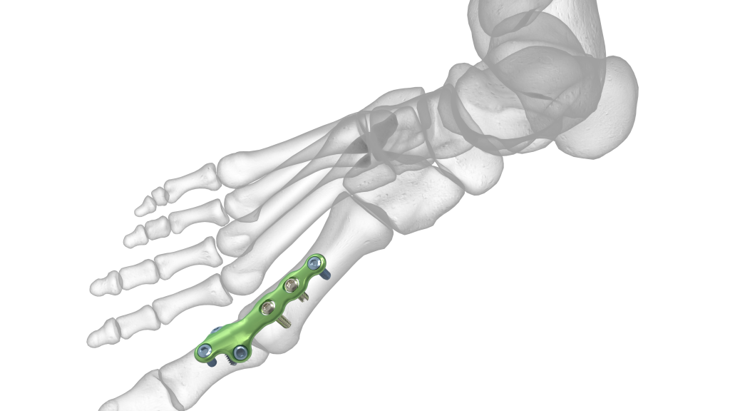 Forefoot-Midfoot Plating System | Acumed