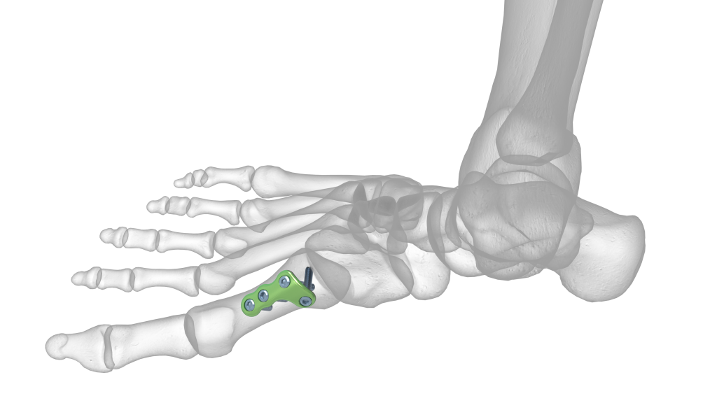 Forefoot-Midfoot Plating System | Acumed