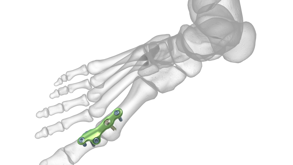 Forefoot-Midfoot Plating System | Acumed