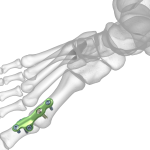 Forefoot-Midfoot Plating System | Acumed
