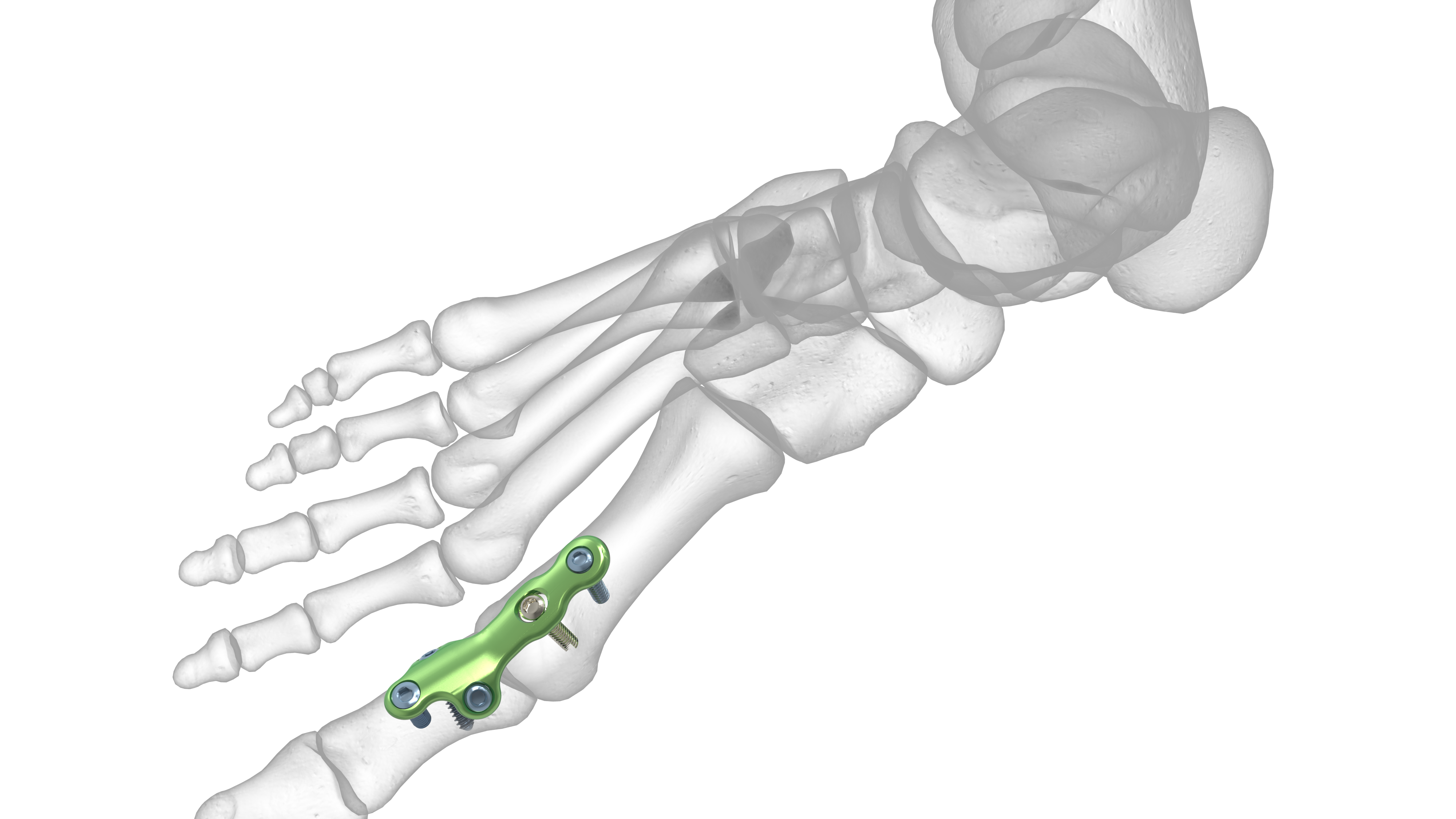 Standard MTP Plate | Acumed