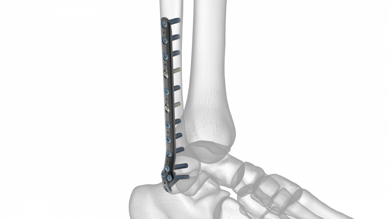 Lateral Fibula Plate | Acumed