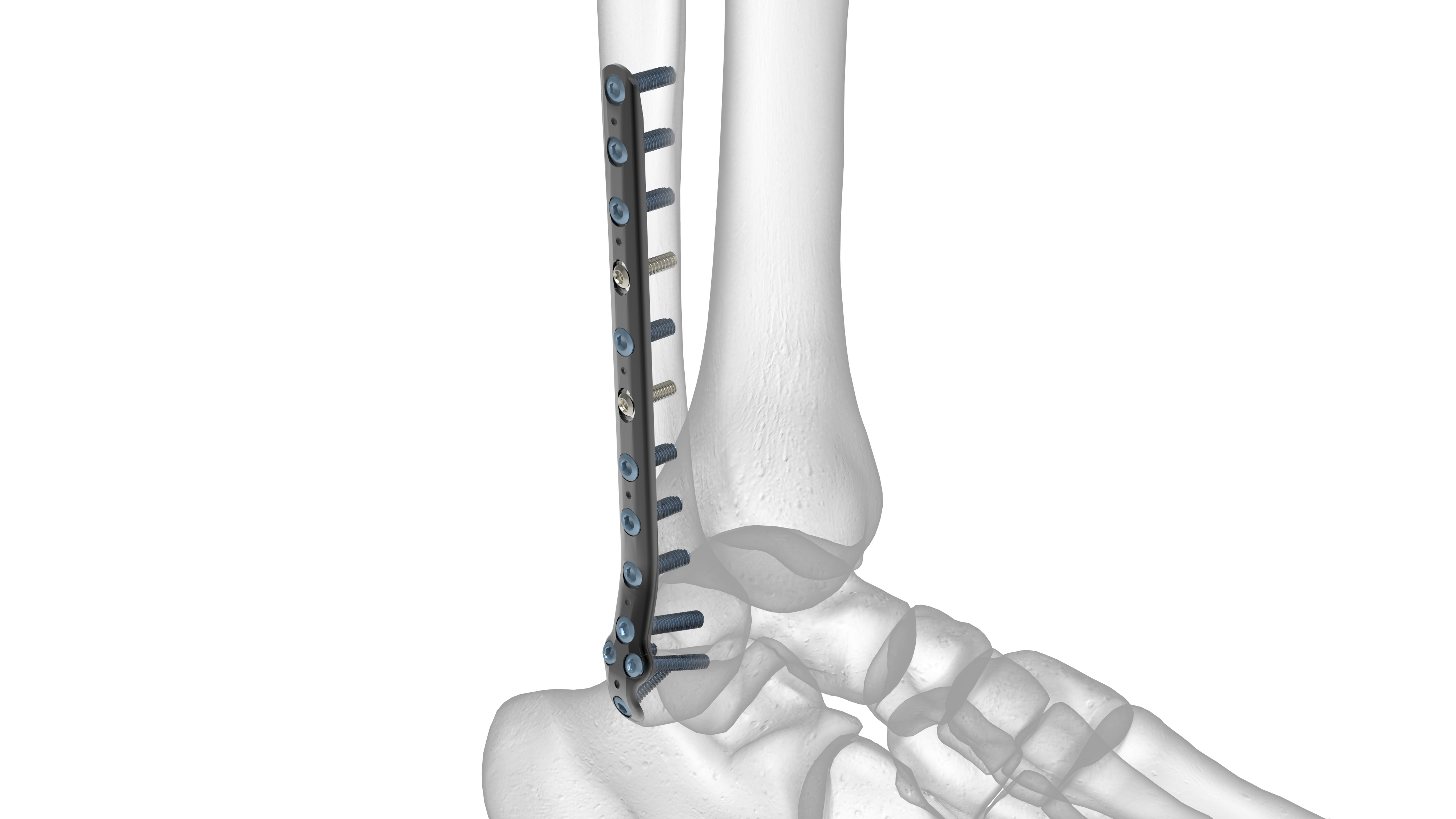 Locking Ankle Plating System | Acumed