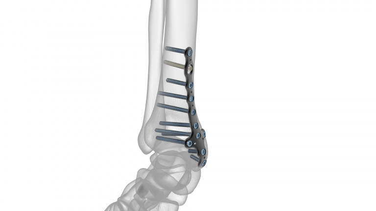 Medial Tibia Plate | Acumed