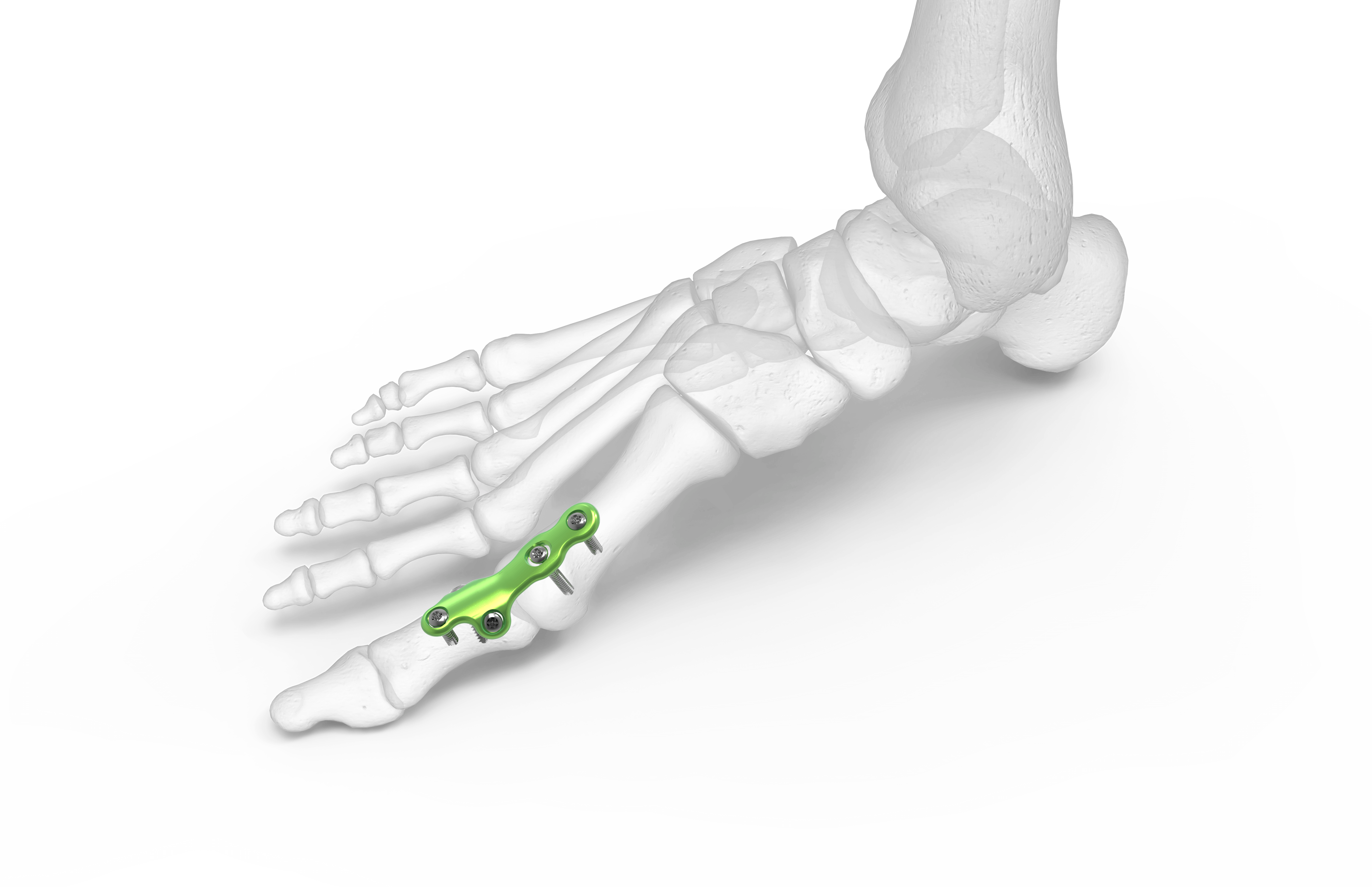 Forefoot-Midfoot Plating System | Acumed