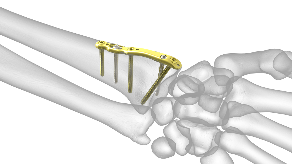 Acu-Loc 2 Wrist Plating System | Acumed