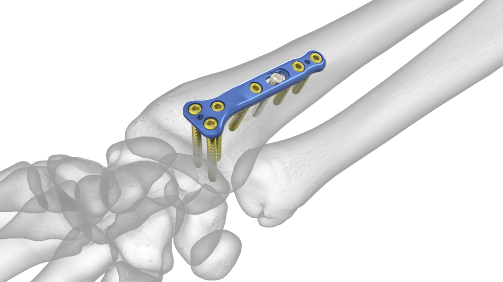 Acu-Loc 2 Wrist Plating System | Acumed