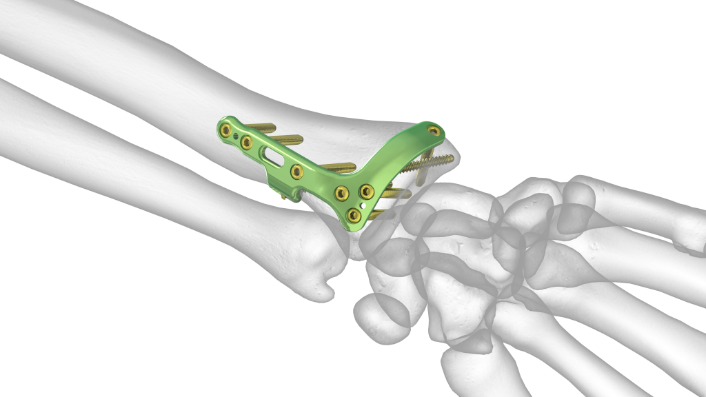 Acu-Loc 2 Wrist Plating System | Acumed