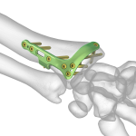 Acu-Loc 2 Wrist Plating System | Acumed