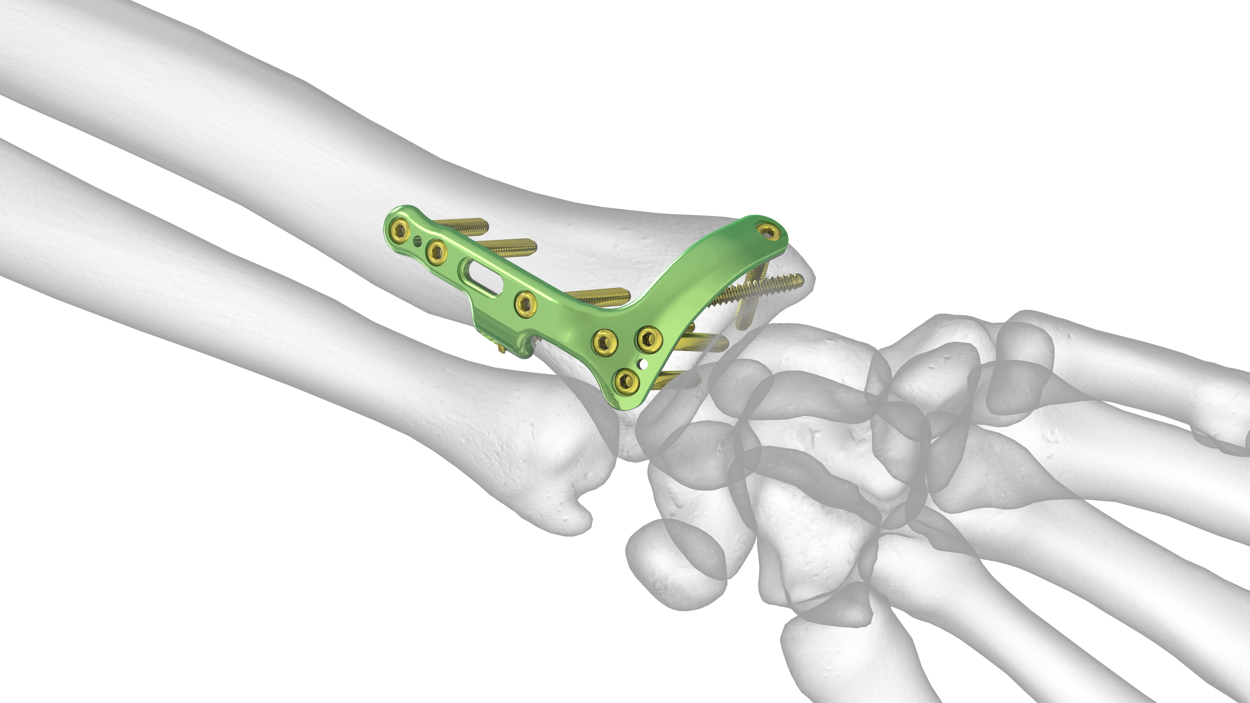 Acu-Loc 2 Wrist Plating System | Acumed