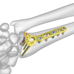 Acu-Loc 2 Wrist Plating System | Acumed