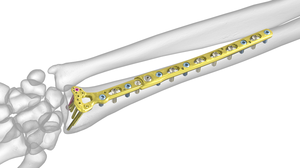 Acu-Loc 2 Wrist Plating System | Acumed