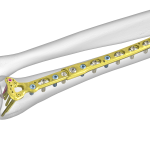 Acu-Loc 2 Wrist Plating System | Acumed