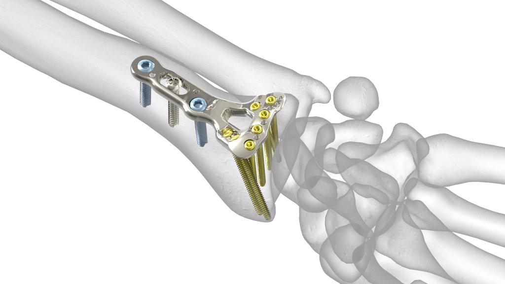 Acu-Loc 2 Wrist Plating System | Acumed