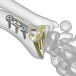 Acu-Loc 2 Wrist Plating System | Acumed