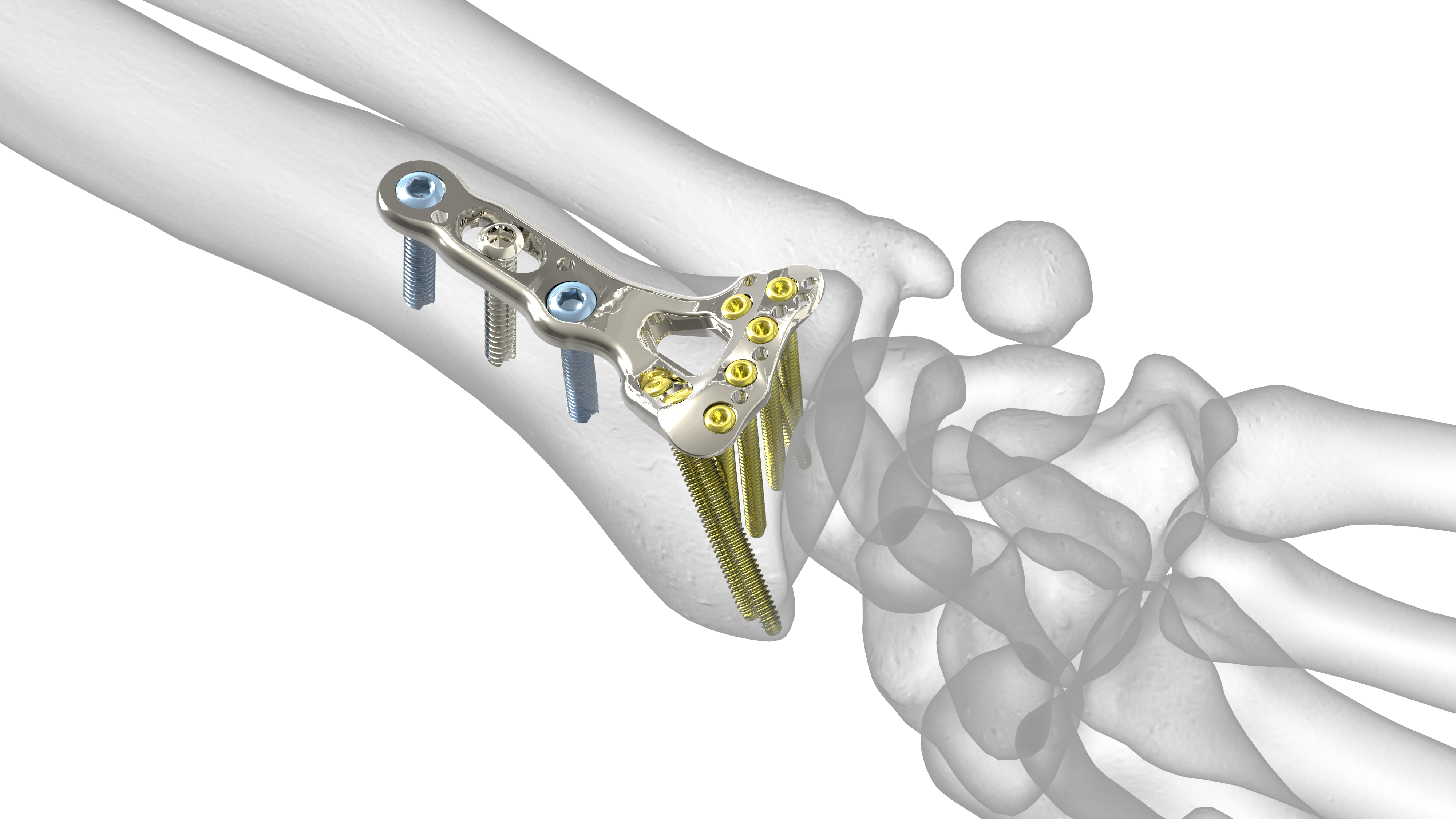 Standard VDR Plate | Acumed