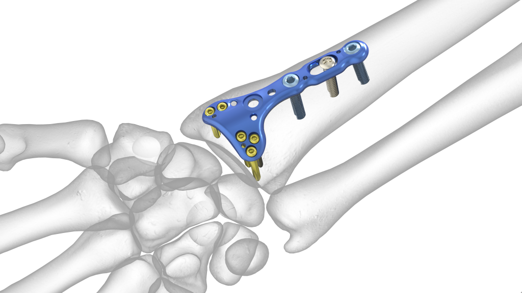 Acu-Loc Wrist Plating System | Acumed