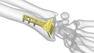 Acu-Loc Wrist Plating System | Acumed