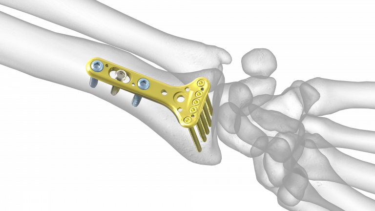 Extra-Articular (EX) Plate | Acumed