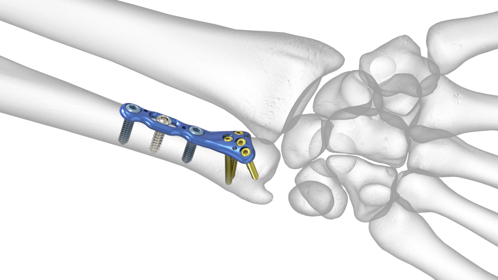 Acu-Loc Wrist Plating System | Acumed