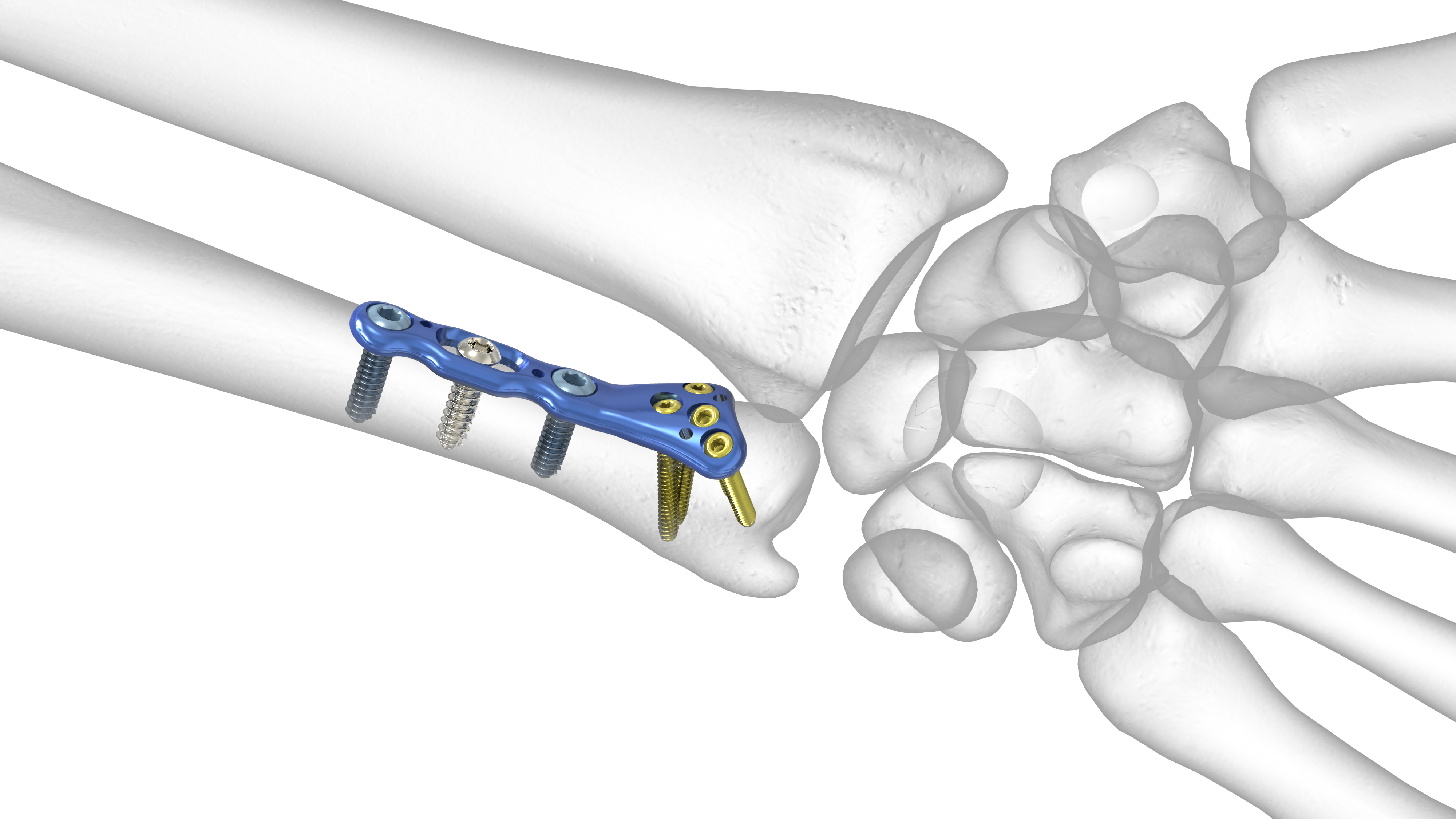 Acu-Loc Wrist Plating System | Acumed