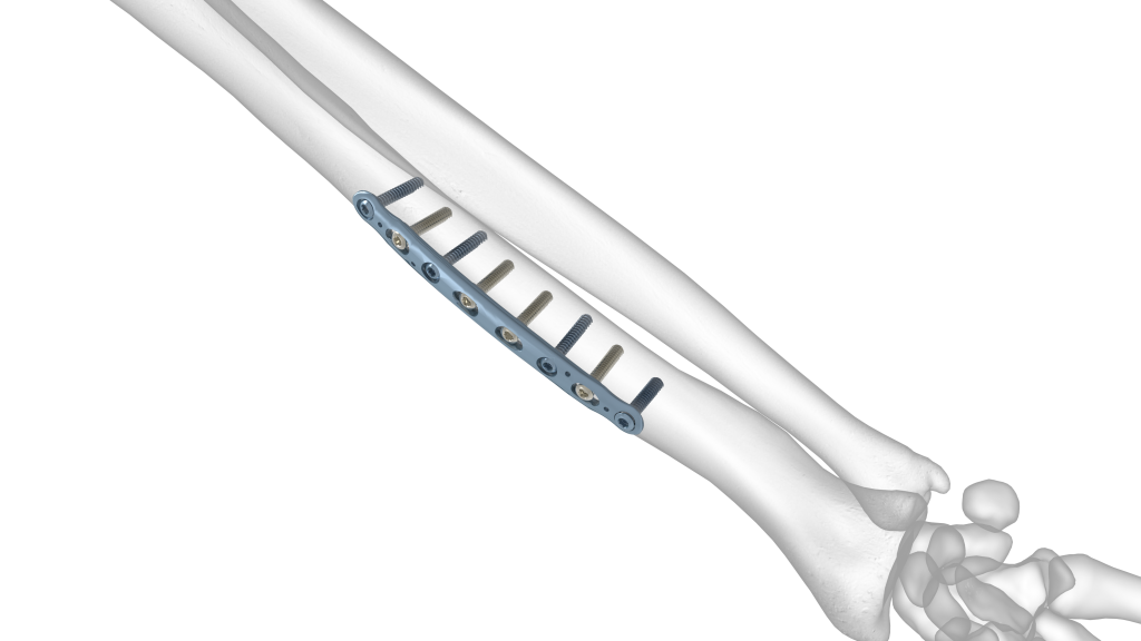 Forearm Fracture Solutions | Acumed