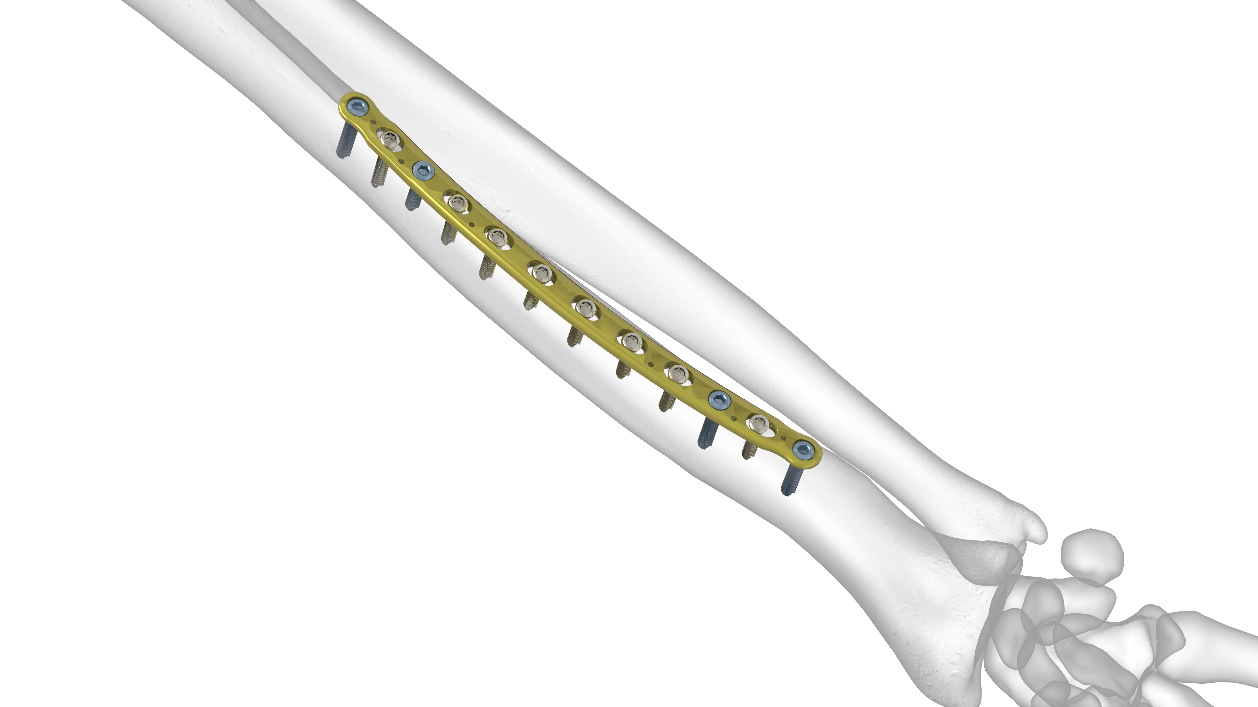 Midshaft Volar Radius Plate | Acumed
