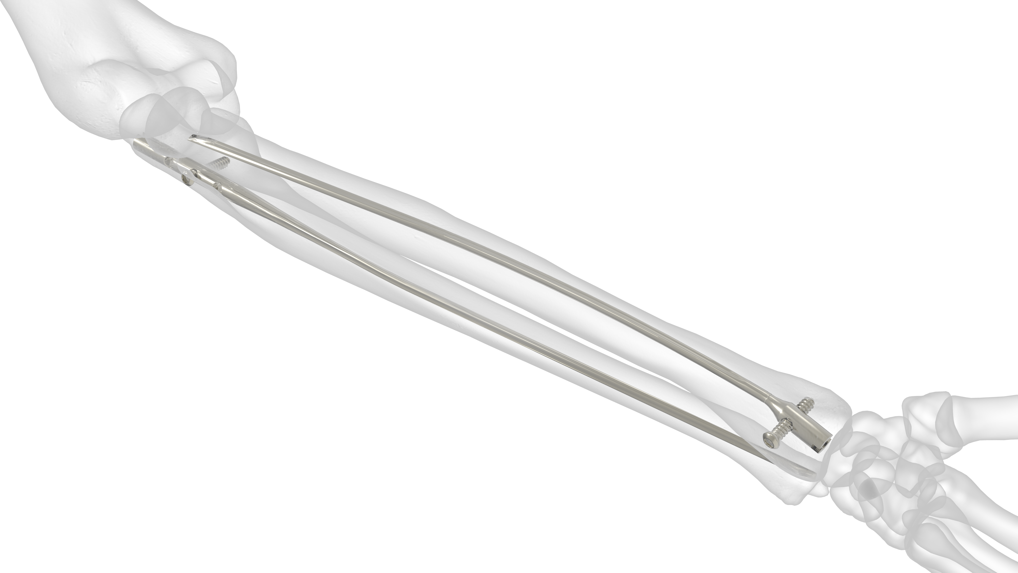 Forearm Fracture Solutions | Acumed
