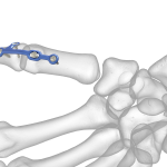 Modular Hand System | Acumed