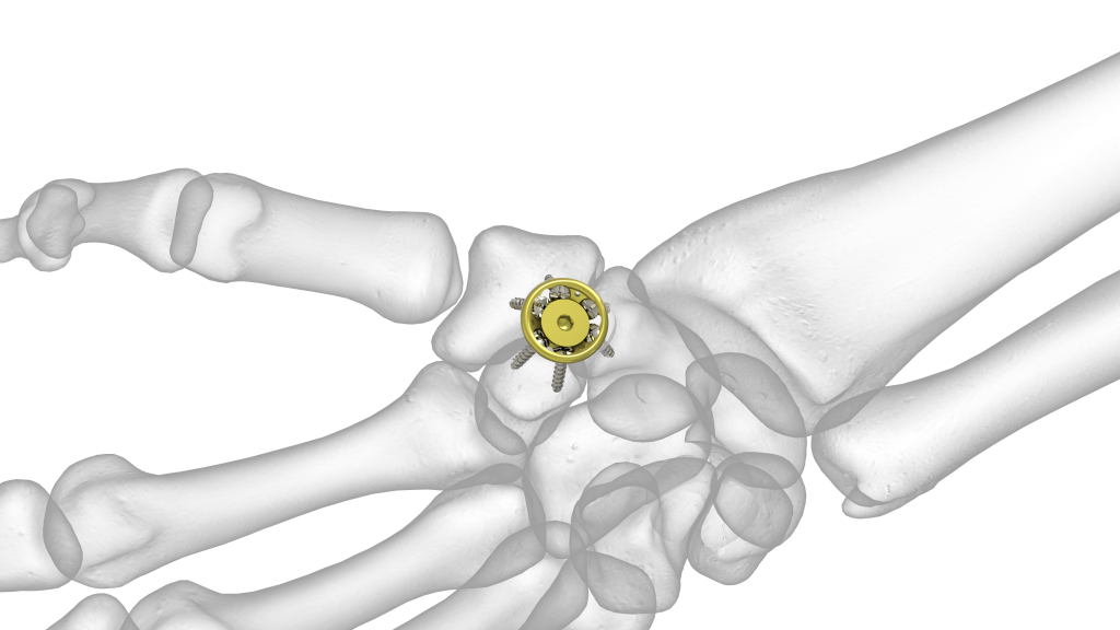 Modular Hand System | Acumed