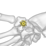 Modular Hand System | Acumed