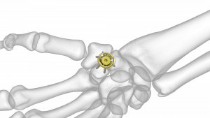 Modular Hand System | Acumed