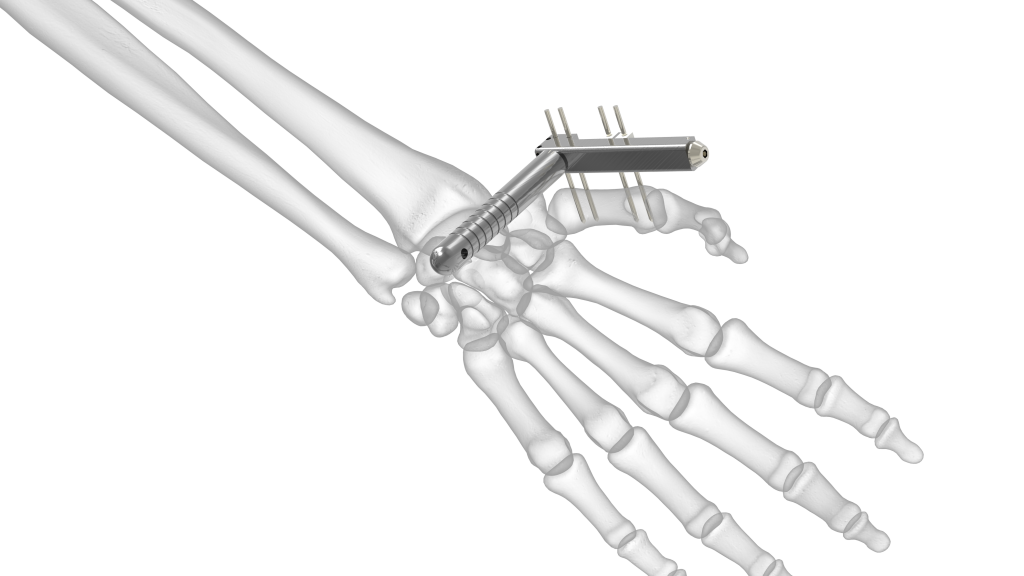 External Fixation System | Acumed