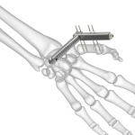 External Fixation System | Acumed