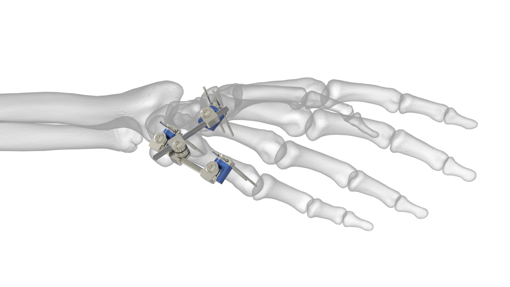 External Fixation System | Acumed
