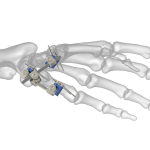 External Fixation System | Acumed
