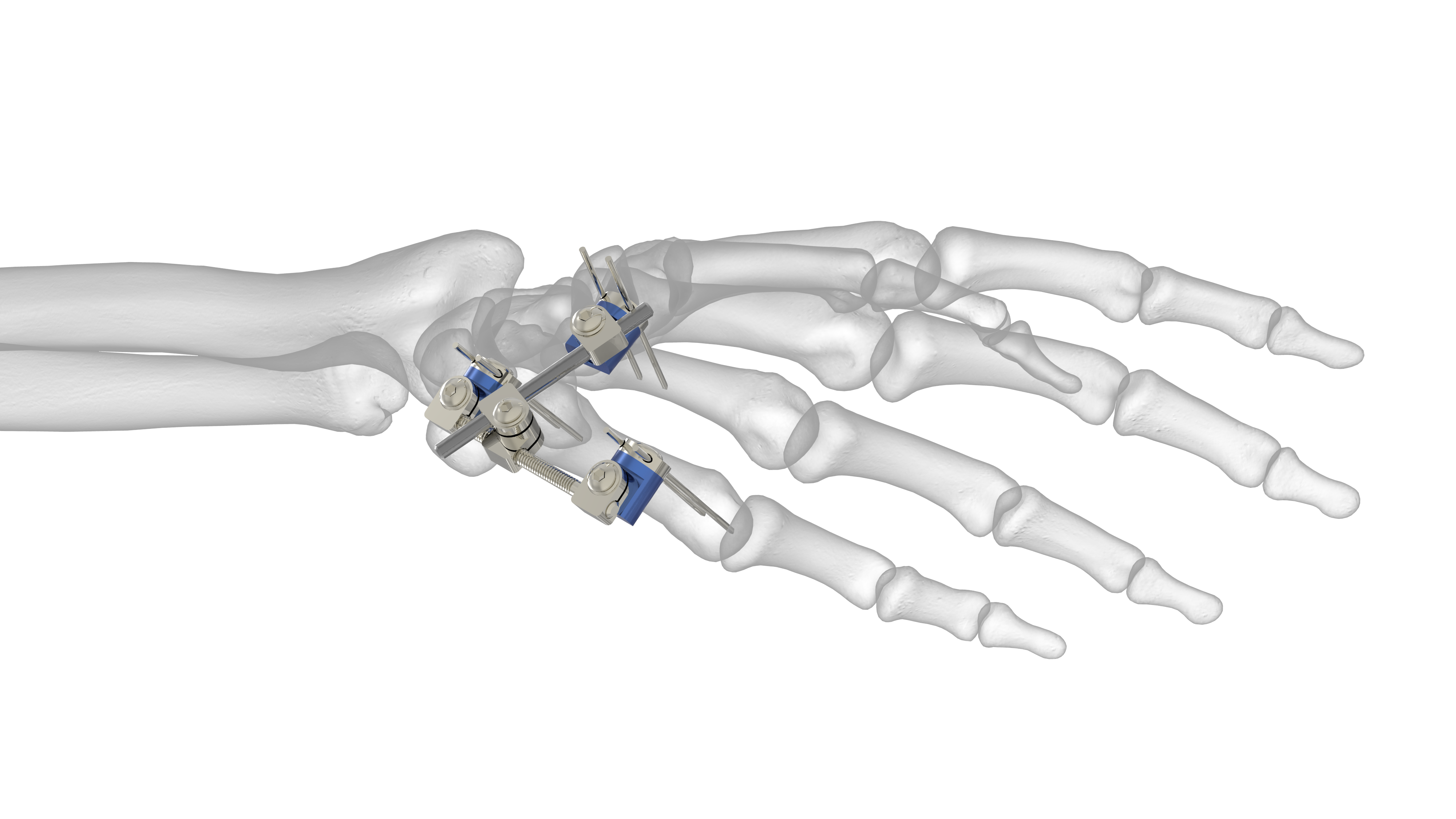 Small Bone Fixator | Acumed