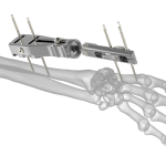 External Fixation System | Acumed