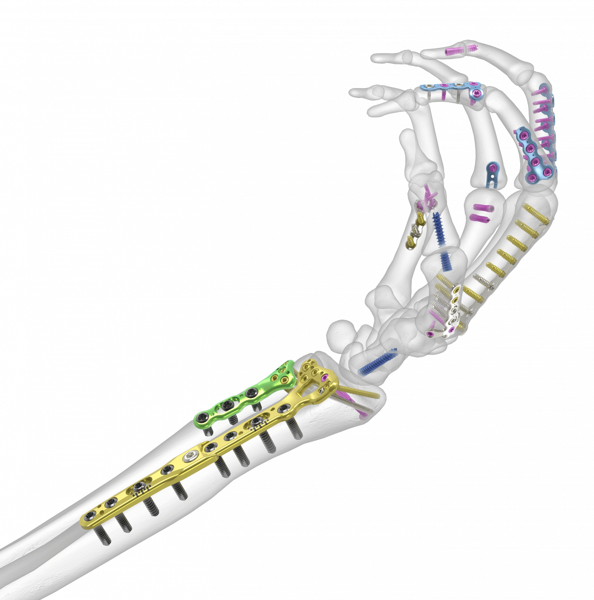 Hand Fracture System, Acu-Loc 2, Acutrak 2 | Acumed