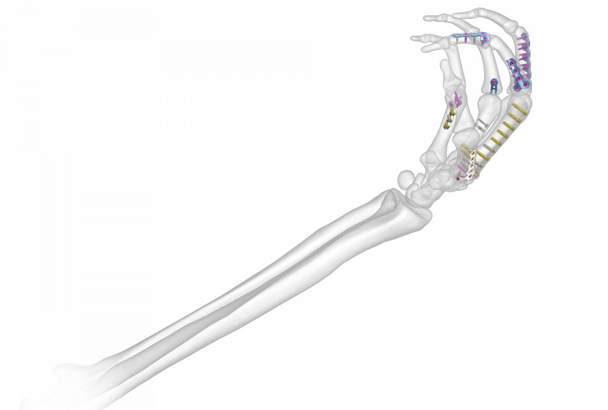 Hand Fracture System | Acumed