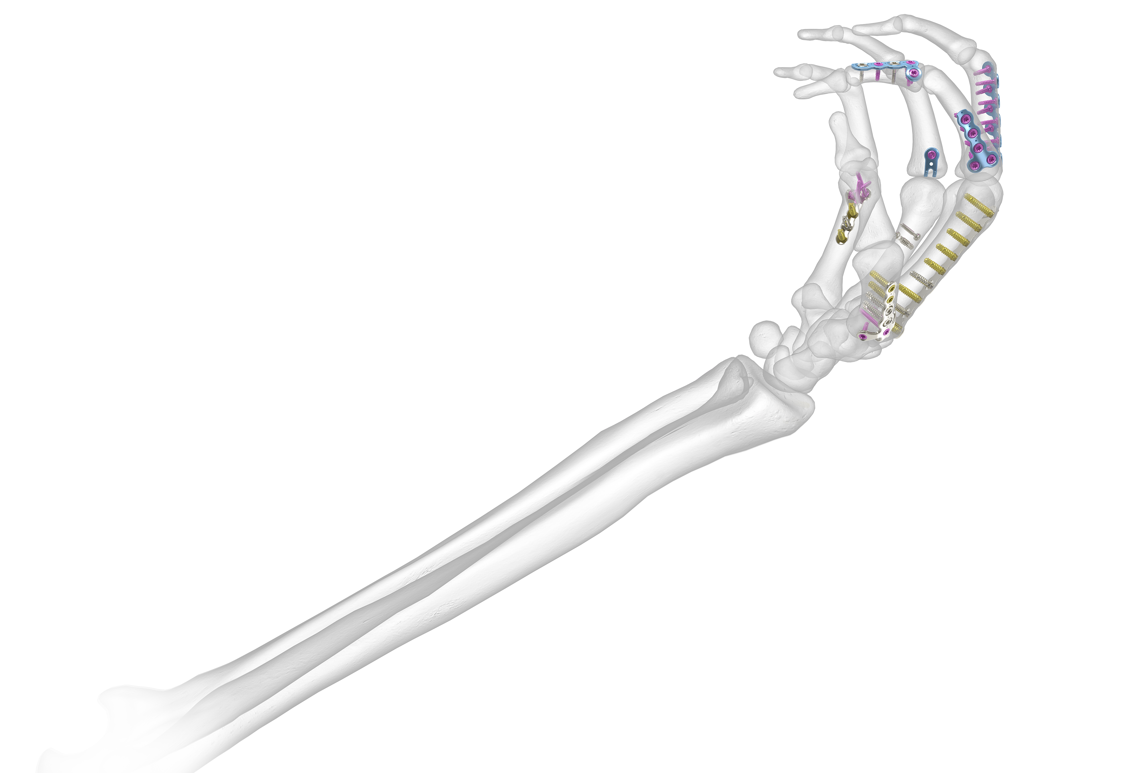 Hand Fracture System | Acumed