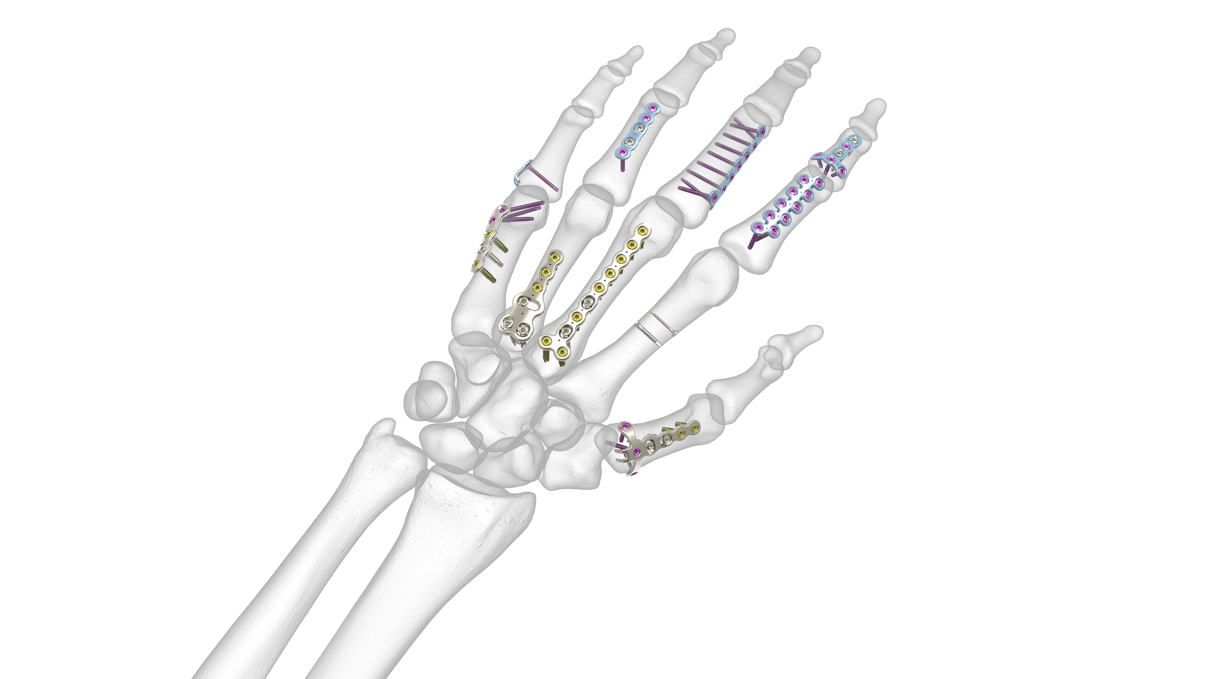 Hand Fracture System On-Bone | Acumed