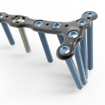 Ankle Plating System | Acumed