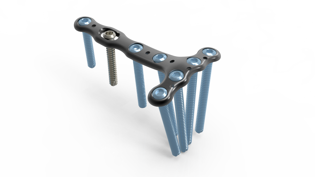 Locking Ankle Plating System | Acumed