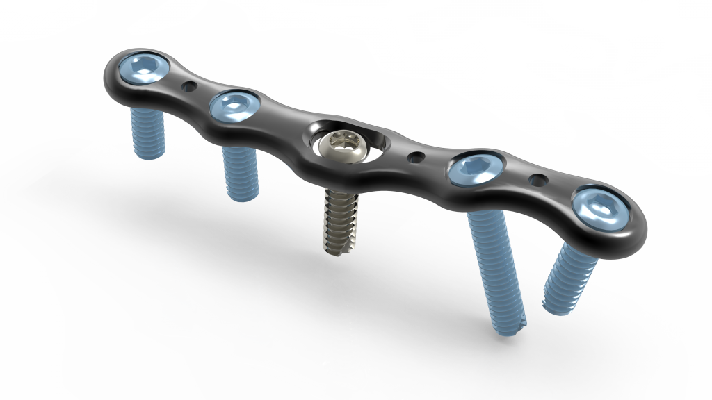 Locking Ankle Plating System | Acumed