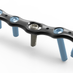 Ankle Plating System | Acumed