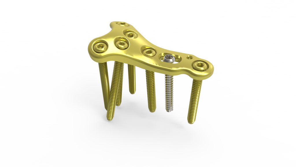 Radial Head Plating System | Acumed