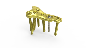 Radial Head Plating System | Acumed