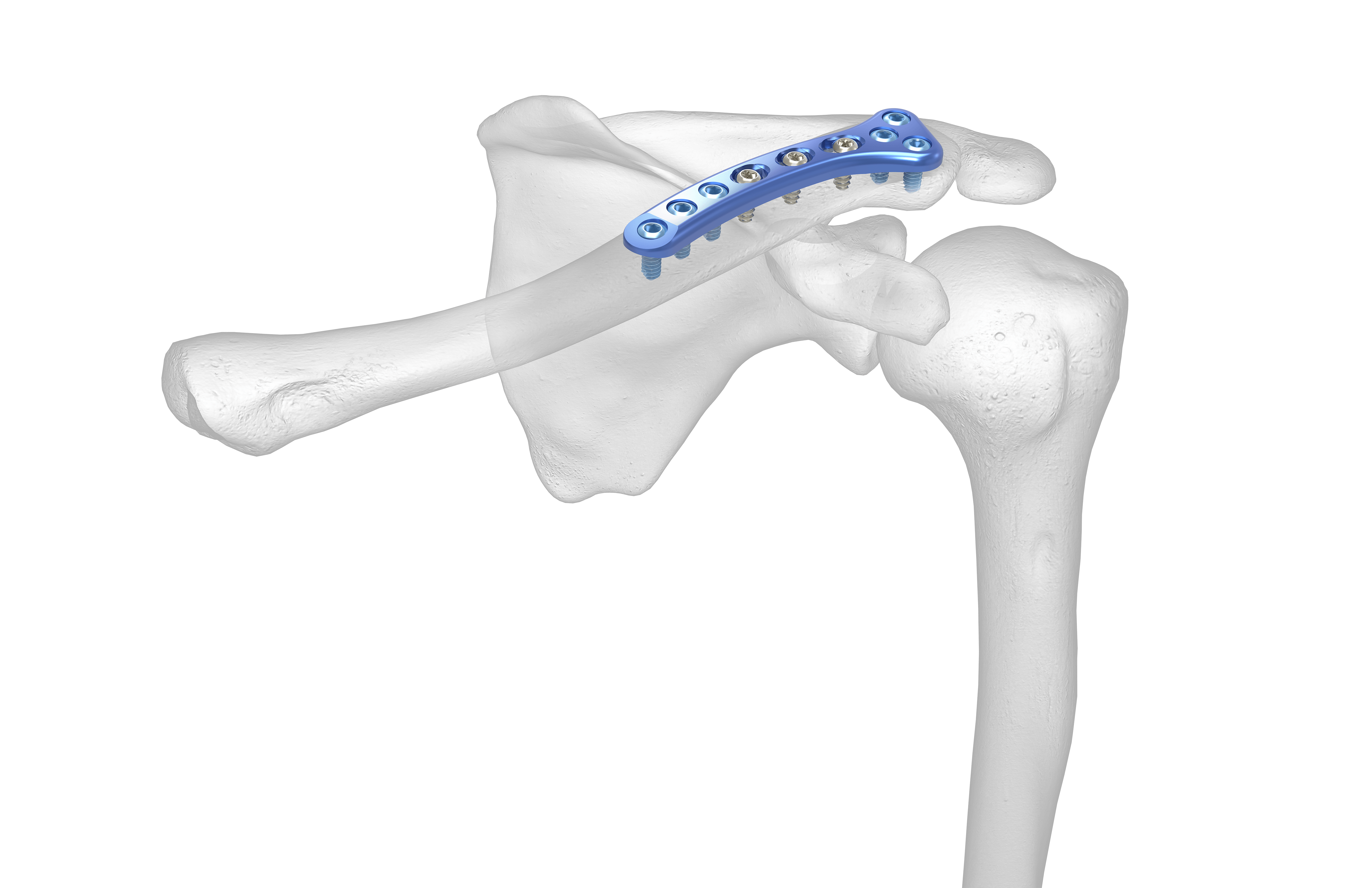 Clavicle Plating System J-Plate | Acumed