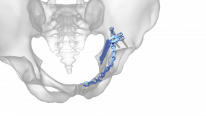 Pelvic Plating System | Acumed